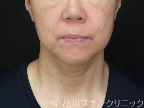 表参道院★林院長による美肌アモーレ（クリスタル）x2（顔：計16本、首：計16本挿入）施術前施術直後 スキンクリニック表参道院 品川美容