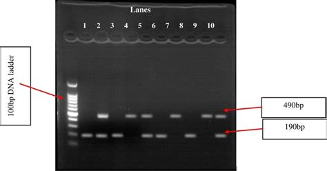 Sample Of Gel Electrophoresis Result Of Ace Id Gene Polymorphism