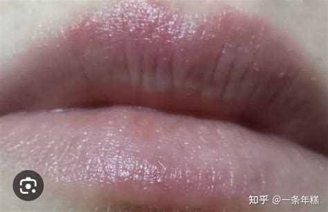 唇炎or唇皰疹 女孩板 Dcard