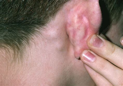 Swollen Lymph Node Behind Ear Treatment