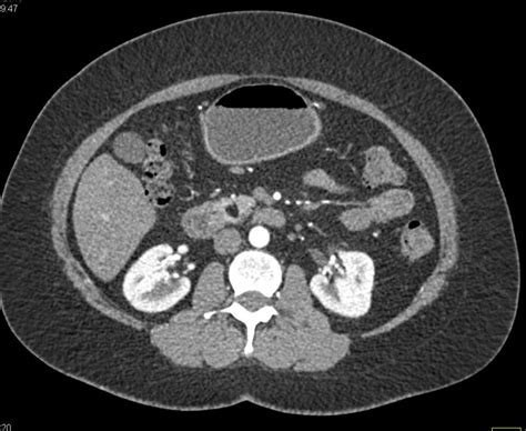 Incidental 1cm Neuroendocrine Tumor In The Head Of The Pancreas