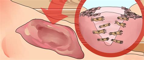 Prioritizing Safety What Is Fibrinous Exudate Tissue In A Wound Tips