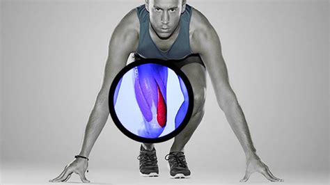 Understanding Vastus Medialis Obliquus Vmo Weakness Causes Implications And Solutions