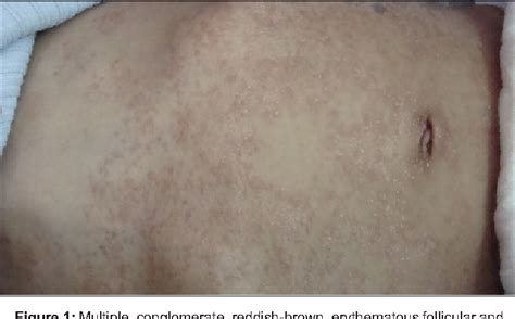 Figure 1 From Lichen Scrofulosorum Presenting As Pyrexia Of Unknown