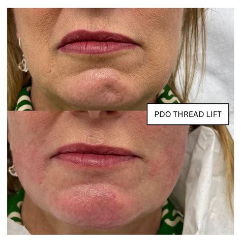 Pdo Threads Doncaster Love Life Aesthetics