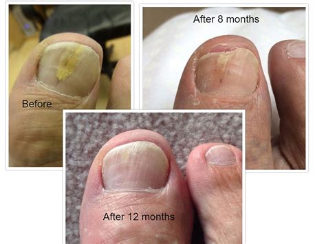 Fungal Nail Laser Uk Footsteps Chiropody And Podiatry Services