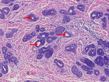 Primary Eccrine Carcinoma With Polymorphous Features In A 20 Year Old