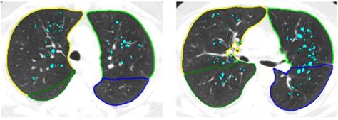 The Potential Role Of Artificial Intelligence In Lung Cancer Screening Using Low Dose Computed