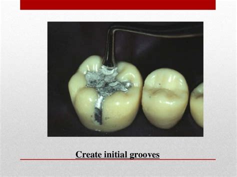 Procedure For Amalgam Restoration