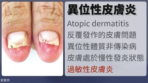 異位性皮膚炎 濕疹的手指 妮寶貝指甲