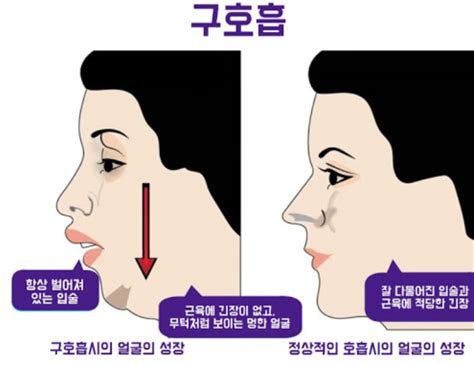 구강호흡 얼굴변형 지식in