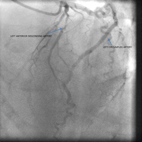 Superdominant Left Circumflex Artery Supplying Significant Proportion