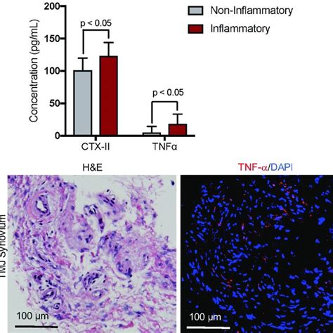 Synovial Fluid And Tissue Derived From Humans With Inflammatory Tmj