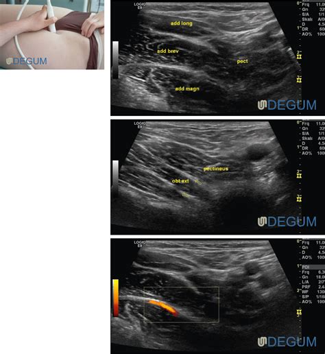 Plexus Lumbalis Und Die Peripheren Nerven Degum