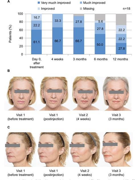 Figure 1 From Cohesive Polydensified Matrix® Hyaluronic Acid Volumizer