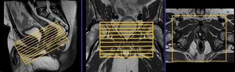 Mri Prostate Protocols Mri Prostate Cancer Multiparametric Planning