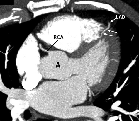 Detection Of Myocardial Bridging With Ecg Gated Mdct And Multiplanar Reconstruction Ajr