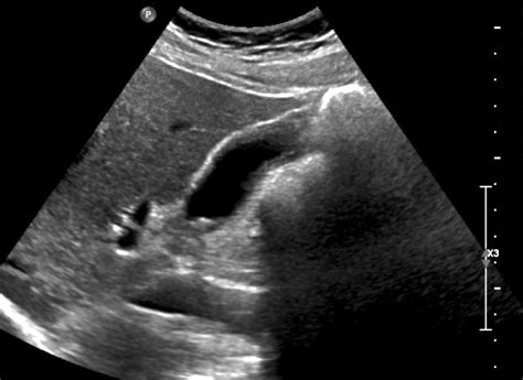 Pathology Outlines Chronic Cholecystitis