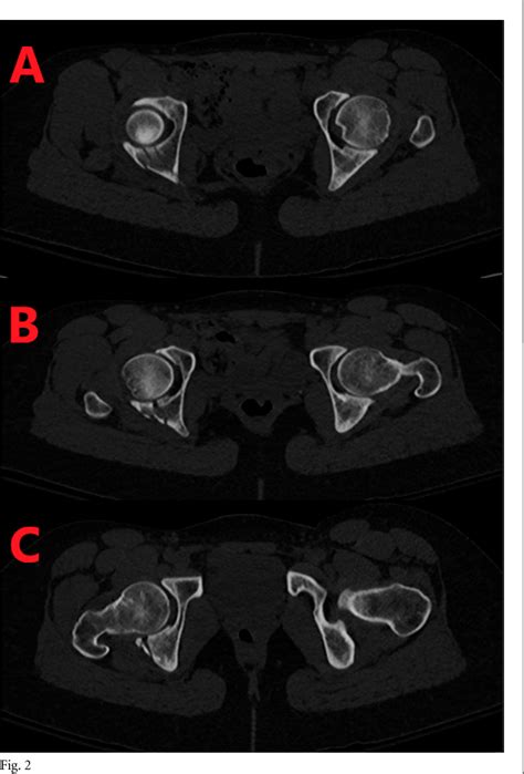 Figure 1 From Heterotopic Ossification Remodeling After Acetabular