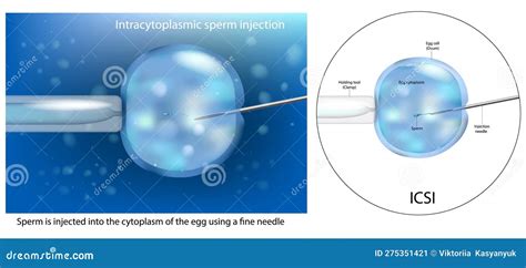 The Procedure Of Intracytoplasmic Sperm Injection Icsi Artificial Insemination In Vitro