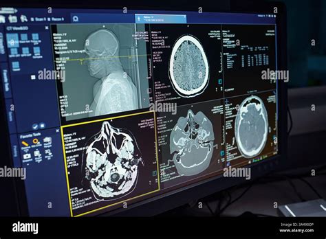 Multiple Brain Scans Displayed On A High Resolution Monitor In Medical Setting With Detailed