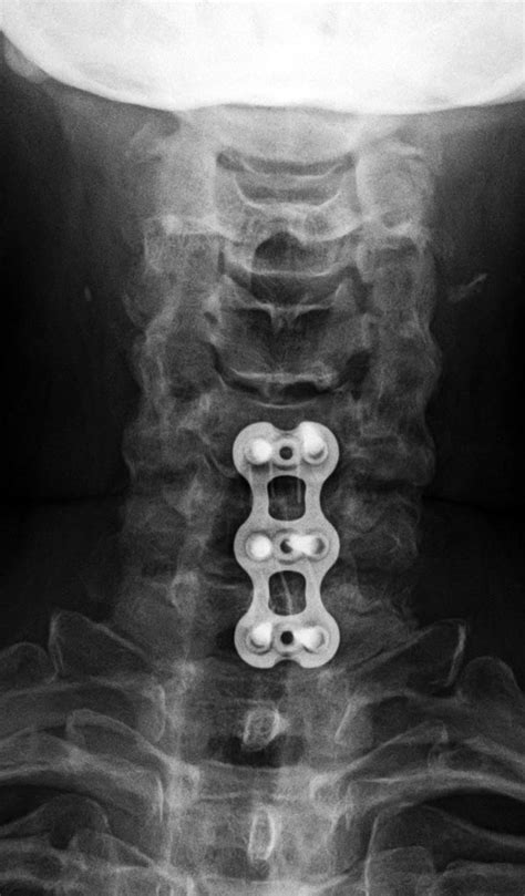 Cervical Fusion Hardware