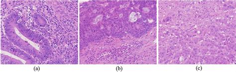 Different Differentiation Types Of Colorectal Cancer By Digital