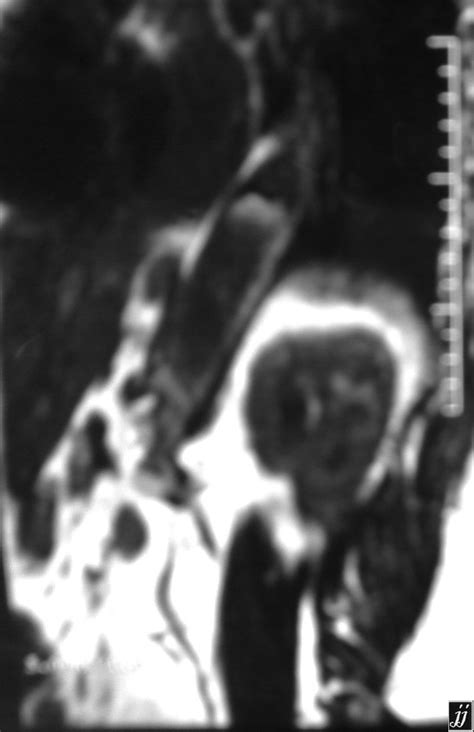 Abdomen Renal Artery Origin Stenosis With Aortic Dissection Mra 13 Radioogle