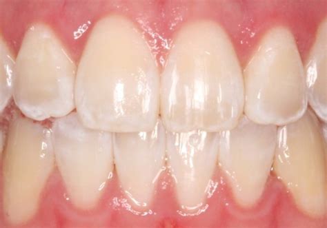 Orthodontic Before And Afters Wentzville Braces Invisalign St Peters