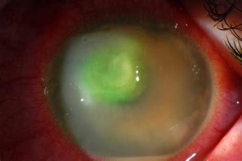 Severe Corneal Abrasion