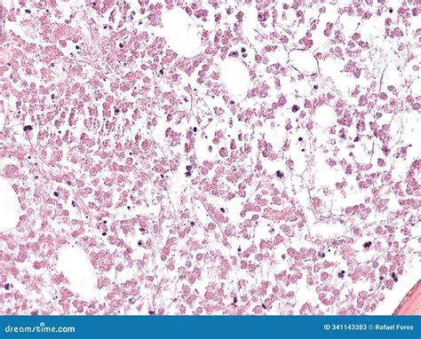 Bone Marrow Necrosis In A Burkitt Lymphoma Stock Image Image Of