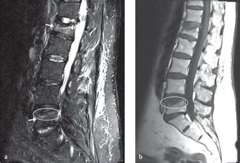 28 Treatment Of Chronic Vertebral Compression Fractures Neupsy Key