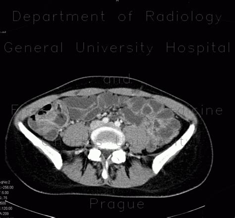 Radiology Case Terminal Ileitis