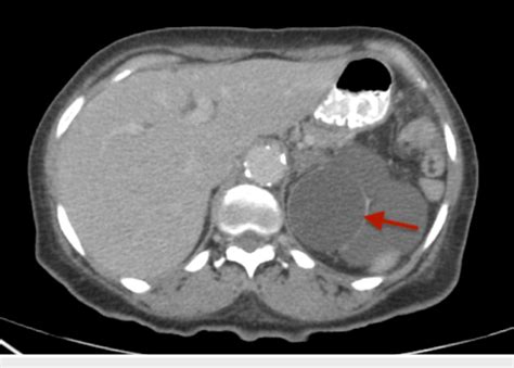 Axial Cect Contrast Enhanced Computed Tomography Scan Of The Abdomen