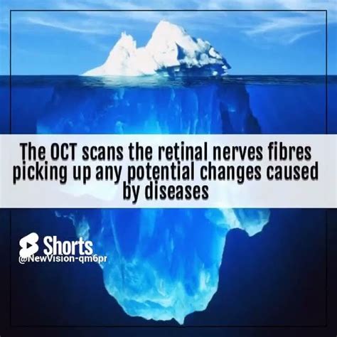 What Is A Oct Scan Discover It With Us Today 🌟👁️ Youtube