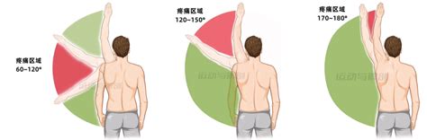 肩部评估干货疼痛弧测试 哔哩哔哩