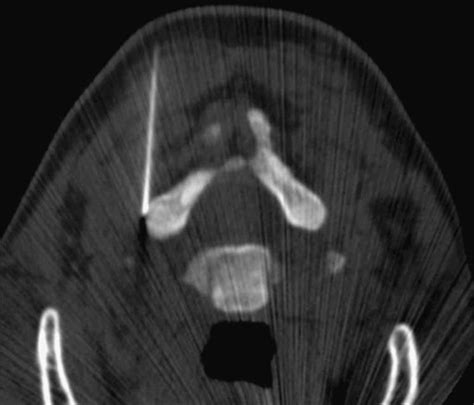Facet Joint Injection Radiology Key