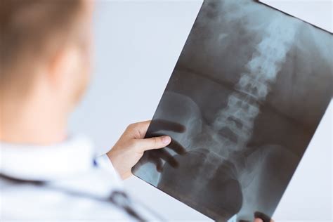 Common Misconceptions About Spinal Surgery Debunking The Myths New