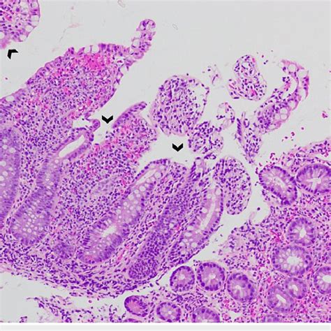 Ileal Mucosa With Erosions Arrowheads Download Scientific Diagram