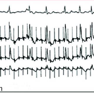 Mechanism And Electrocardiographic Pattern Of Typical Atrial Flutter Download Scientific