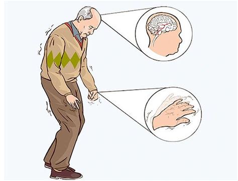 Bệnh Parkinson người cao tuổi nên biết DayCare DayCare