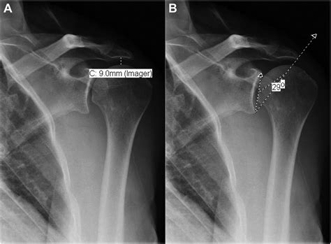 Pseudoparesis And Pseudoparalysis In The Setting Of Massive Irreparable Rotator Cuff Tear