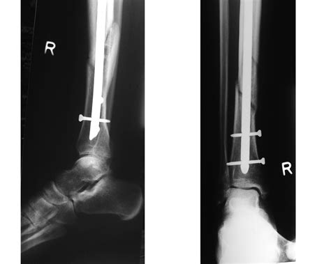 Steel Rod Tibia Fixation
