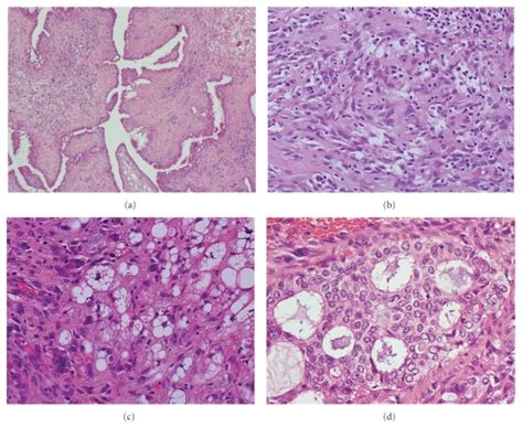 Pathological Features Within Phyllodes Tumour A Leaf Like