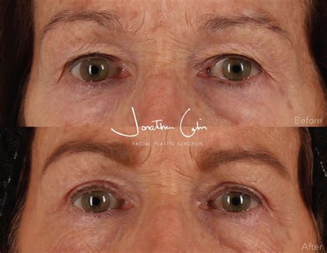 Upper Blepharoplasty Cabinmd Facial Plastics And Aesthetics