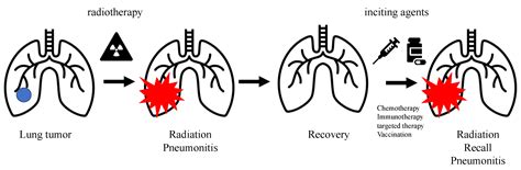 Cancers Free Full Text Radiation Recall Pneumonitis A Rare
