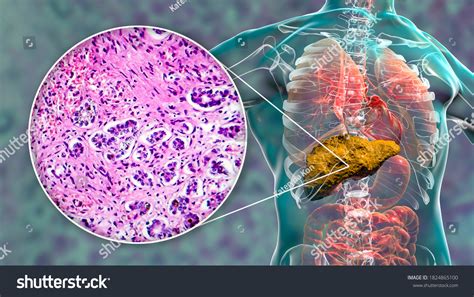 Hepatic Steatosis Photos And Images Shutterstock