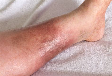 What Is Dvt — Vein Institute