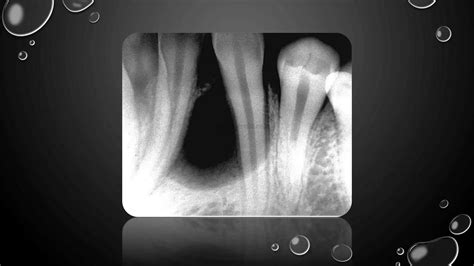 Adenomatoid Odontogenic Tumor Pptx