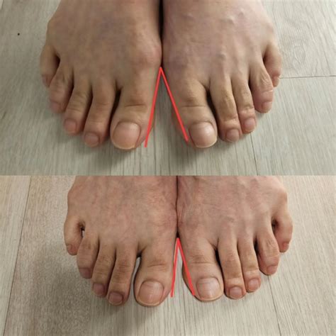 춘천 필라테스 정형외과에서 해결 못 하는 여성의 90 무지외반증 교정 가능할까 네이버 블로그